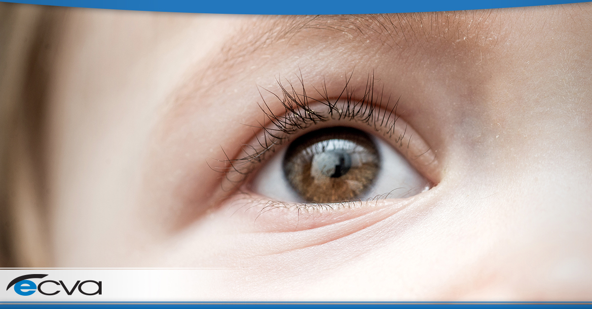 Congenial (Pediatric) Cataracts – What It Is and How It’s Treated