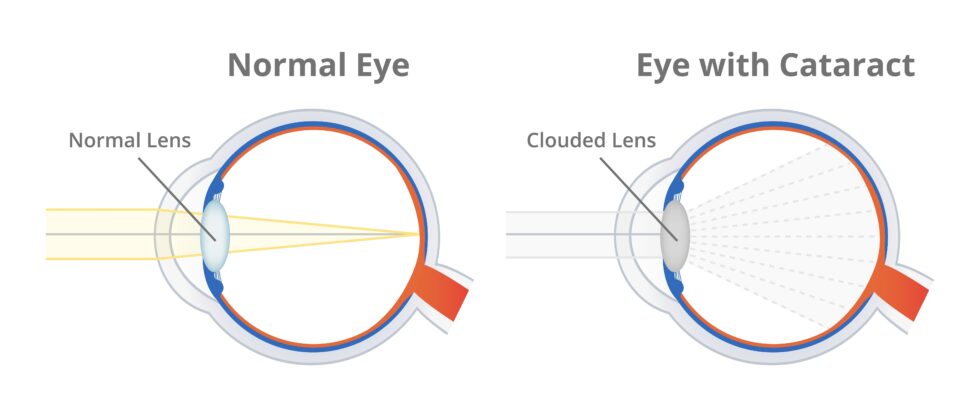 What Does Vision Look Like Through Different Stages of Cataracts? - Eye ...